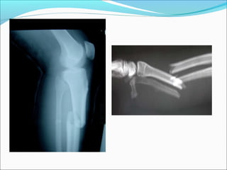 compartment syndrome | PPT