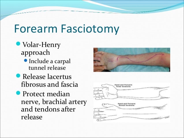 compartment syndrome