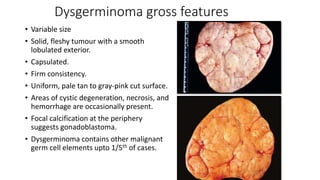 Ovary Dysgerminoma Gross