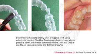 Seminar clear aligner 1 | PPT