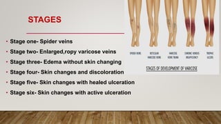 VARICOSE VEINS | PPTX