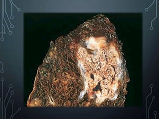 Necrosis ; Pathology ; MBBS Topic ; Seminar Topic ; Cell Death by ...