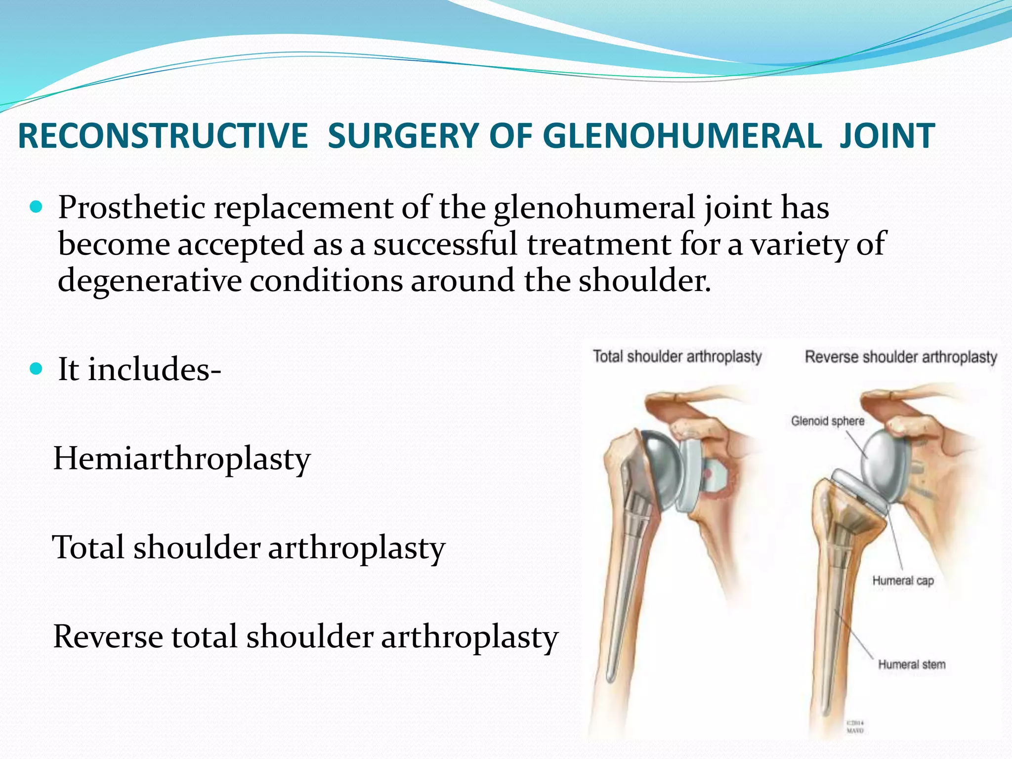 Seminar recent advances reverse shoulder arthroplasty | PPTX