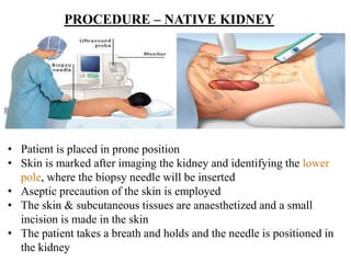 Renal Biopsy Gun