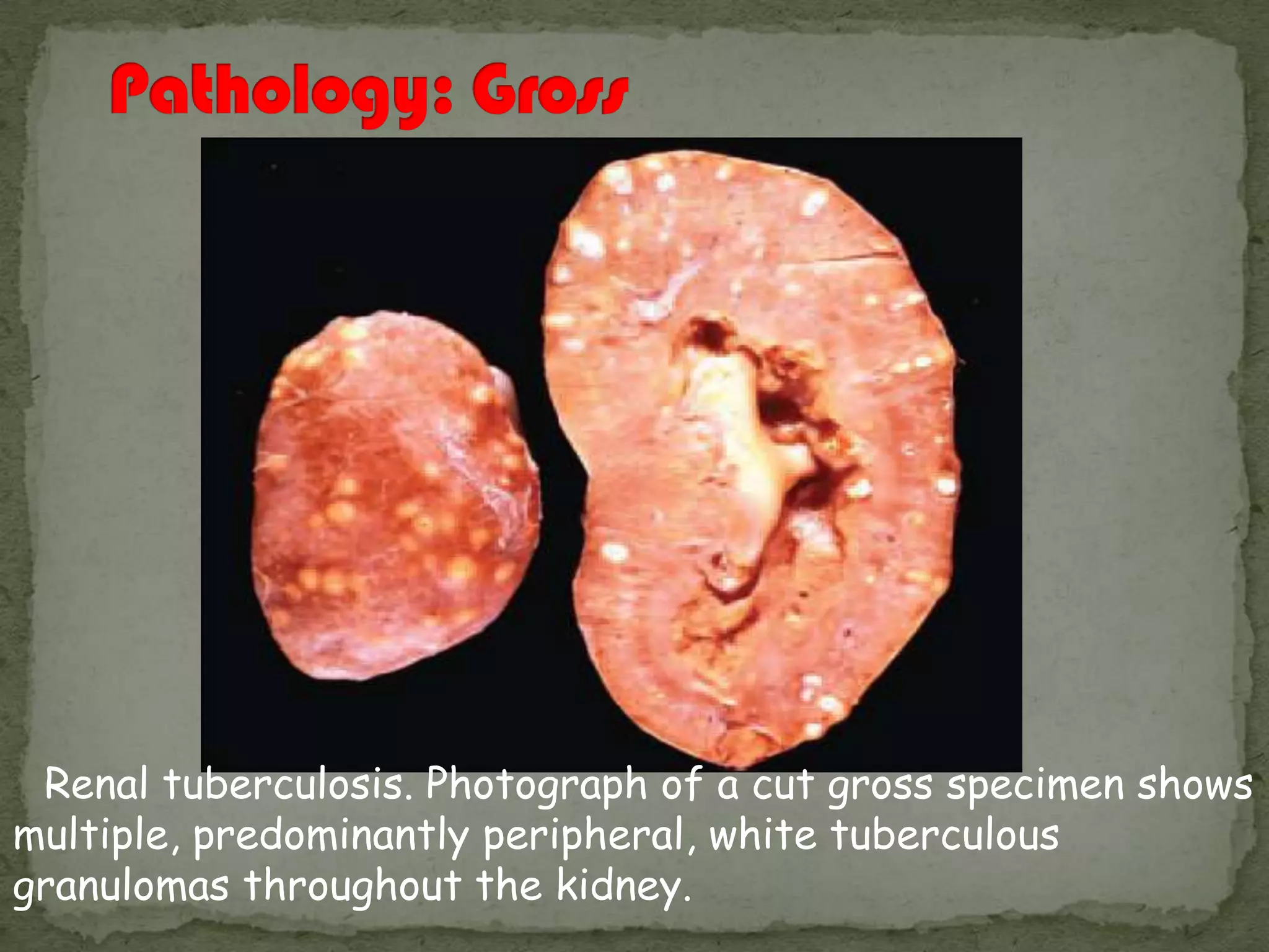 Seminar on renal tuberculosis | PPTX