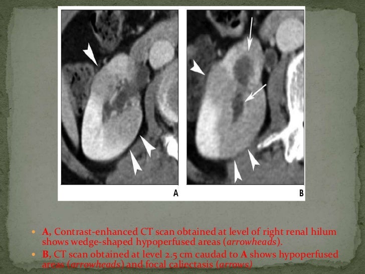 Seminar on renal tuberculosis