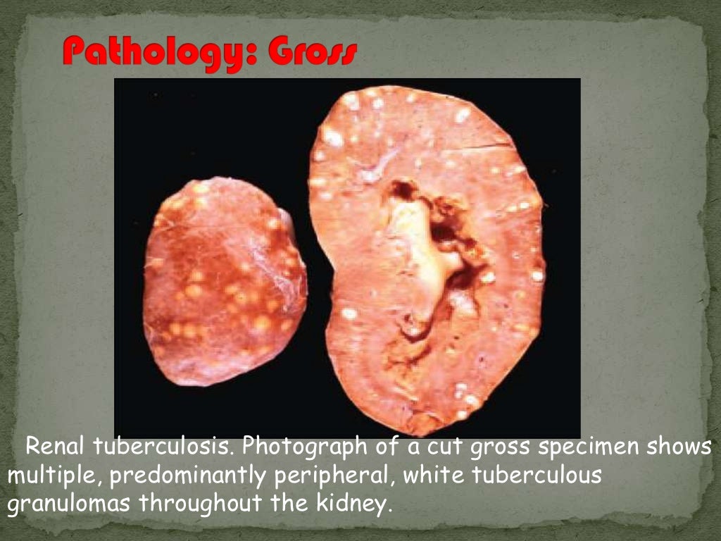 Seminar on renal tuberculosis