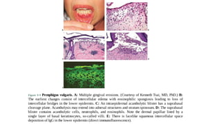 Vesiculobullous lesions of skin including intraepidermal and ...