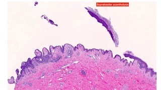 Vesiculobullous lesions of skin including intraepidermal and ...