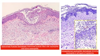 Vesiculobullous lesions of skin including intraepidermal and ...