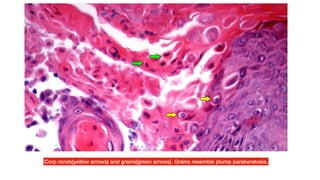 Vesiculobullous lesions of skin including intraepidermal and ...