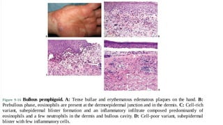 Vesiculobullous lesions of skin including intraepidermal and ...