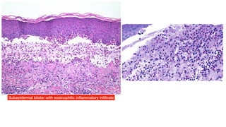 Vesiculobullous lesions of skin including intraepidermal and ...