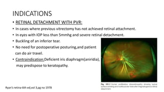 Vitreous substitutes in ophthalmology | PPTX
