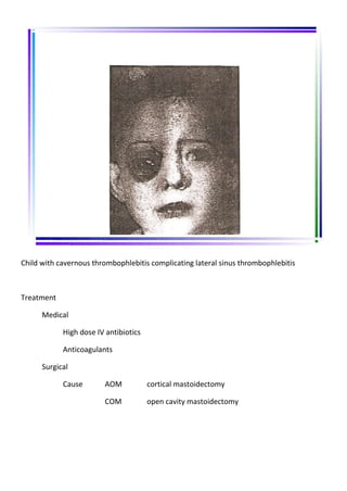 Intracranial complications of CSOM | PDF
