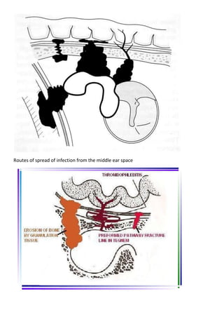 Intracranial complications of CSOM | PDF