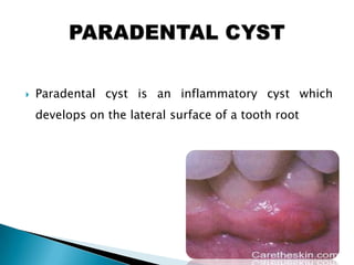 Paradental Cyst