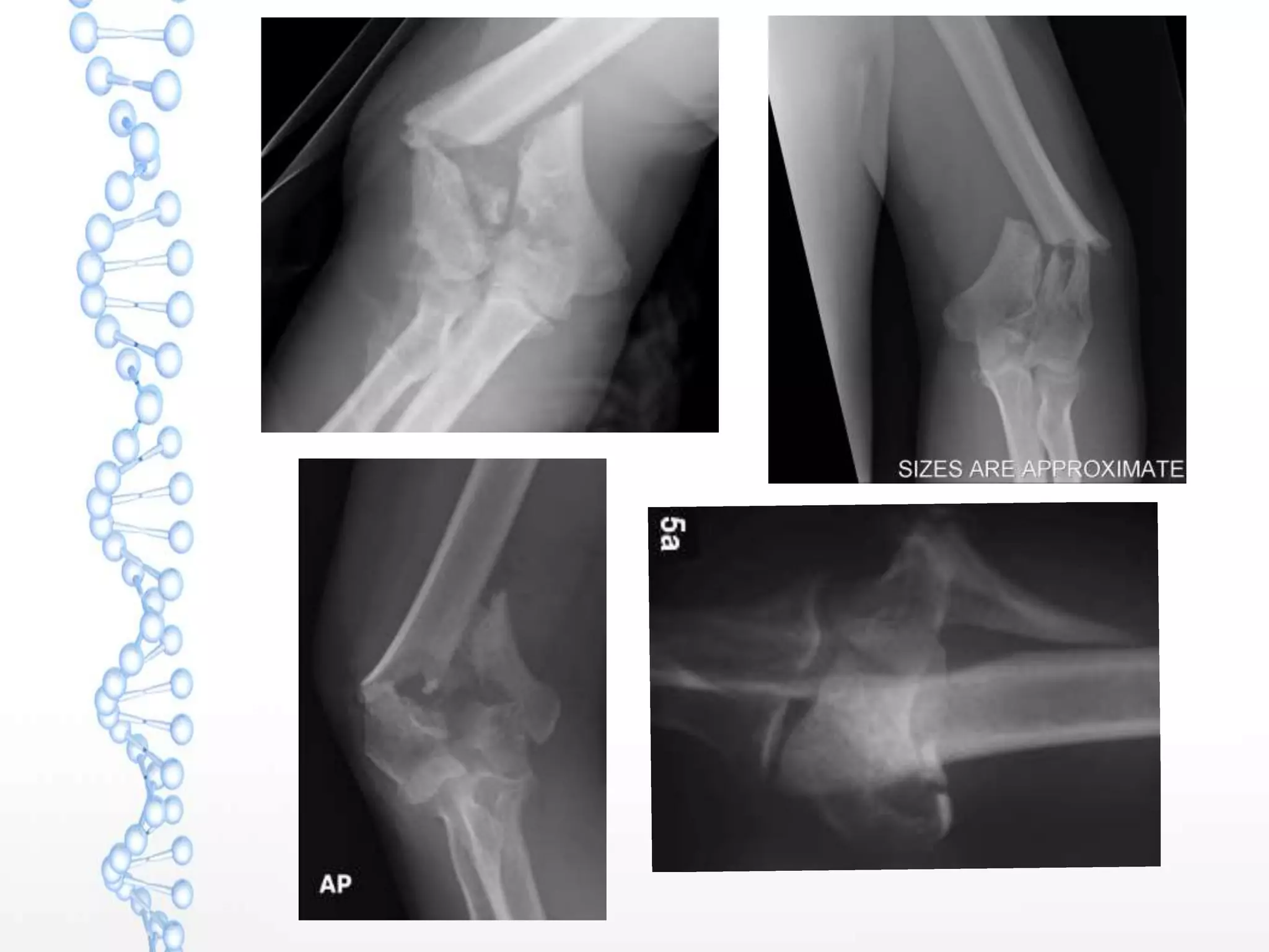 Distal humerus fracture and elbow dislocation | PPTX