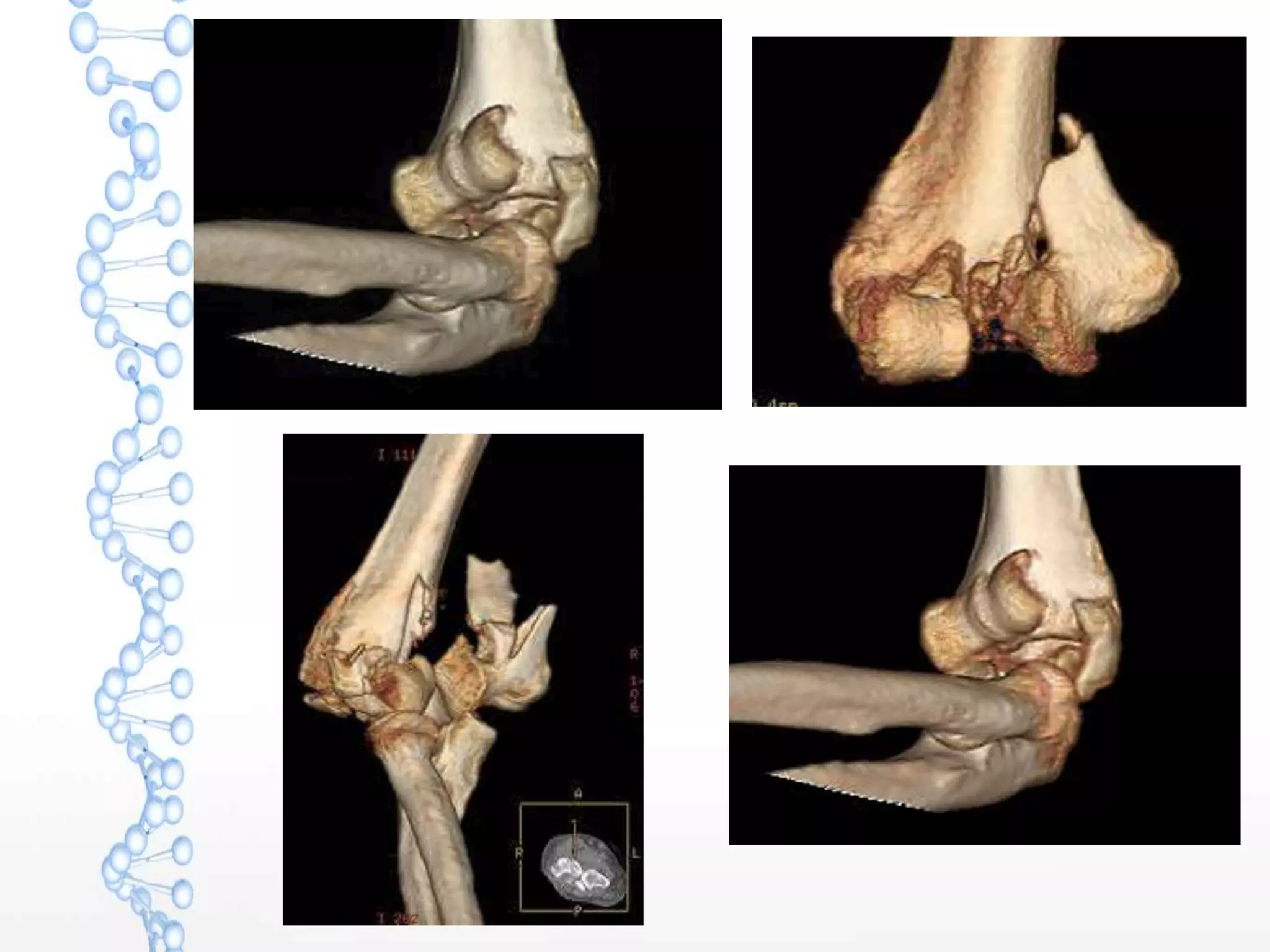 Distal humerus fracture and elbow dislocation | PPTX