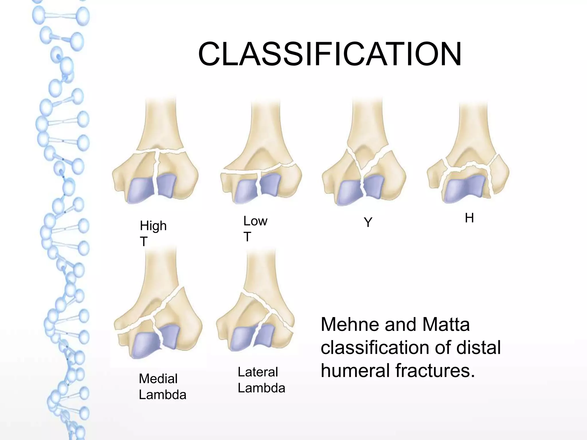 Distal humerus fracture and elbow dislocation | PPT