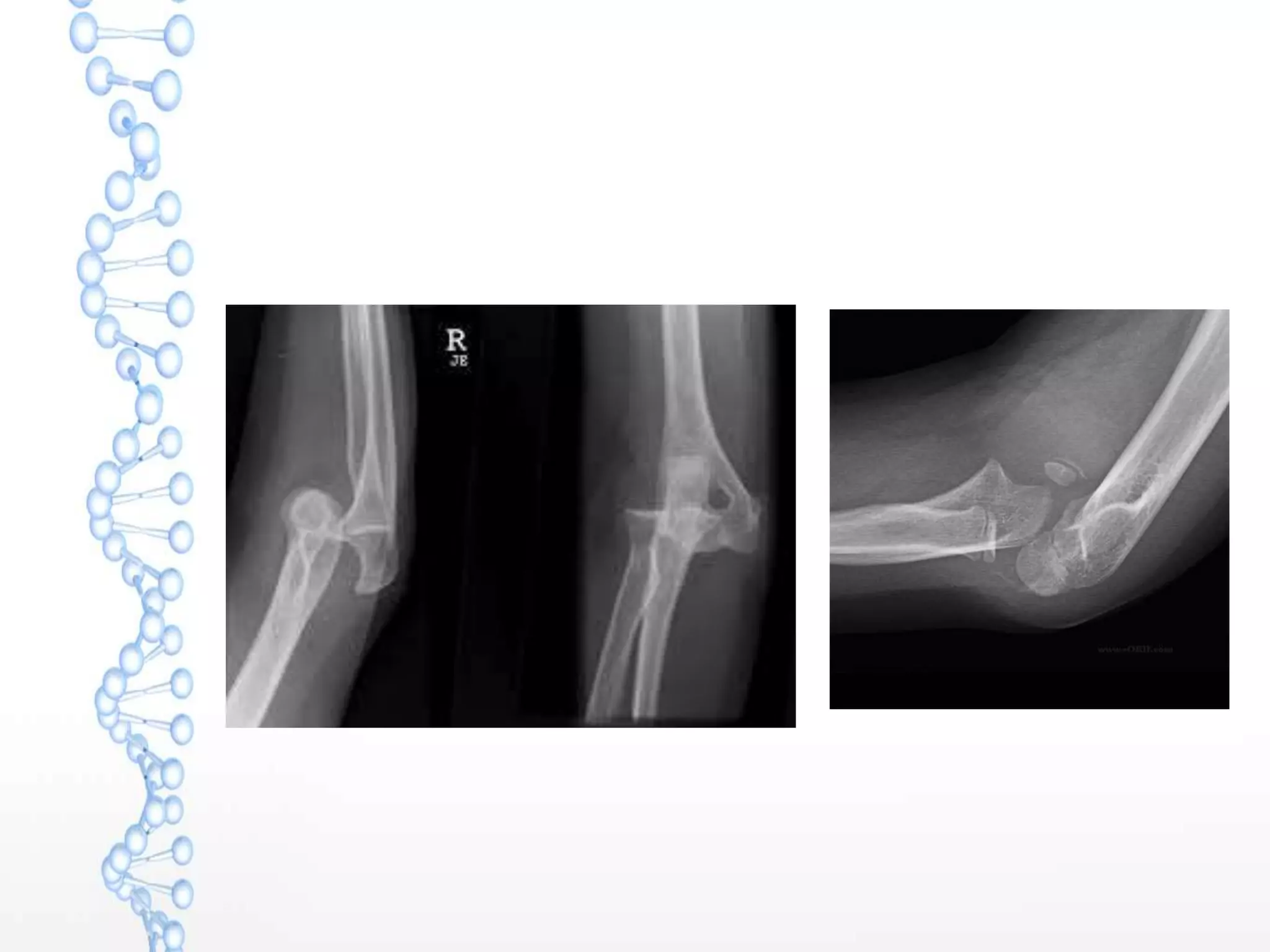 Distal humerus fracture and elbow dislocation | PPTX