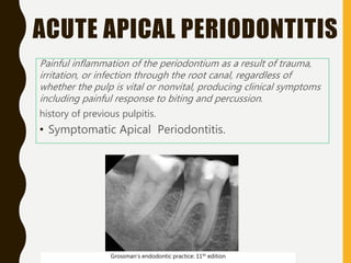 Acute Apical Periodontitis