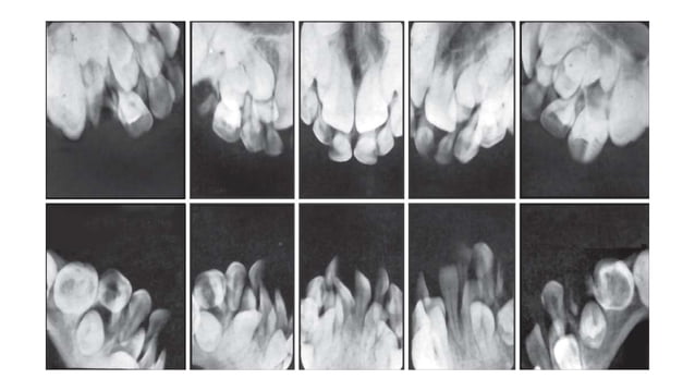 radiographic manifestations of endocrine disorders.pptx