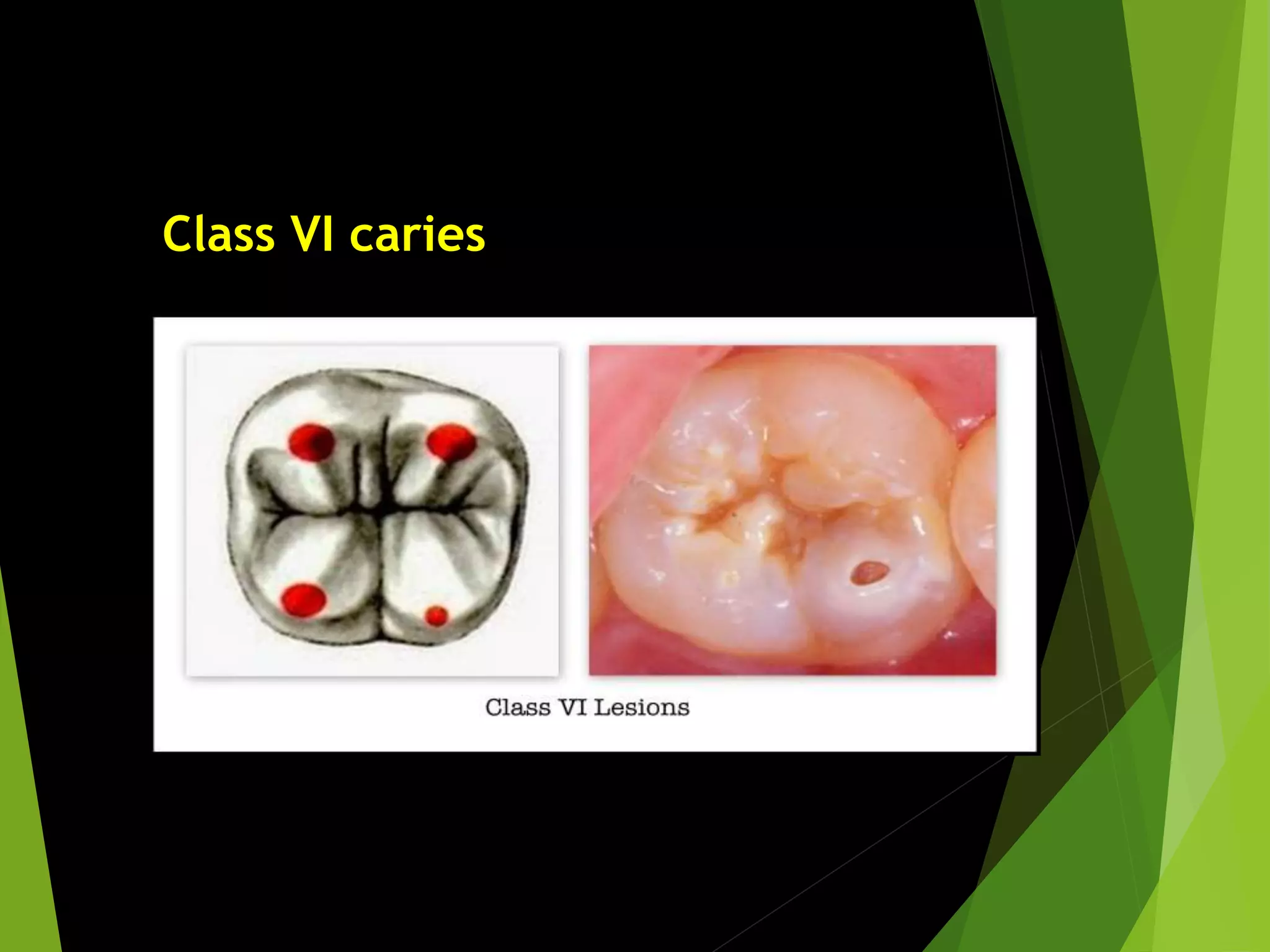 Dental caries | PPTX
