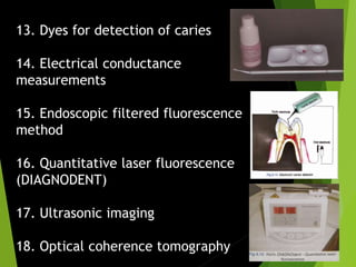 Dental caries | PPTX