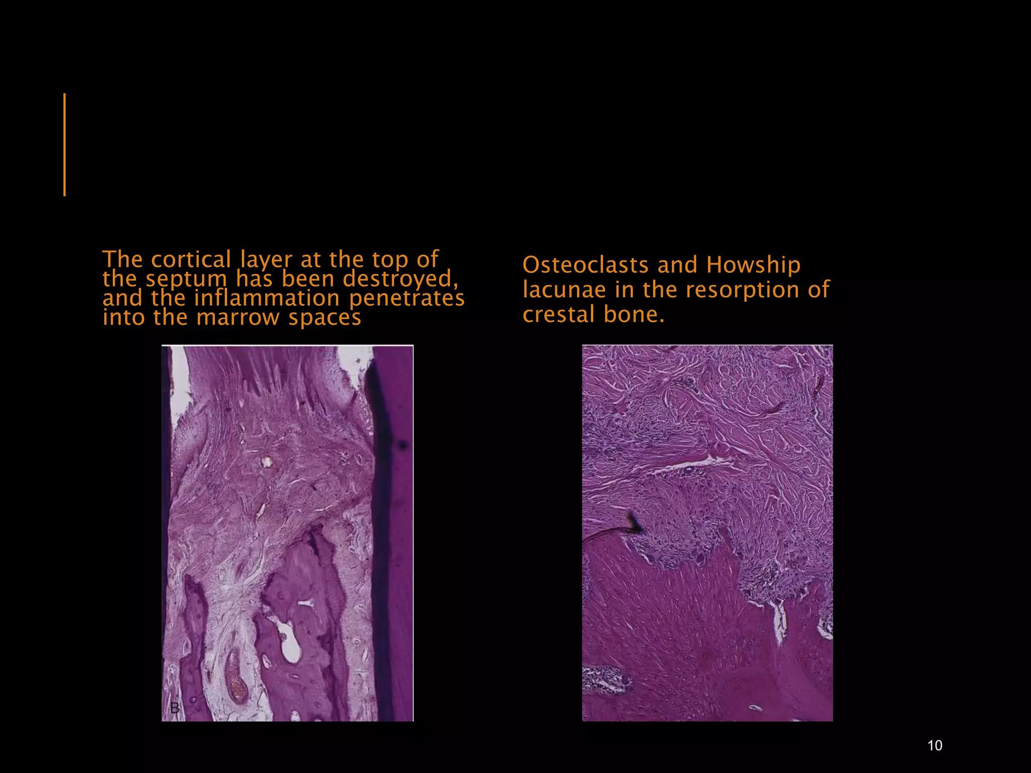 Periodontal bone defects | PPTX