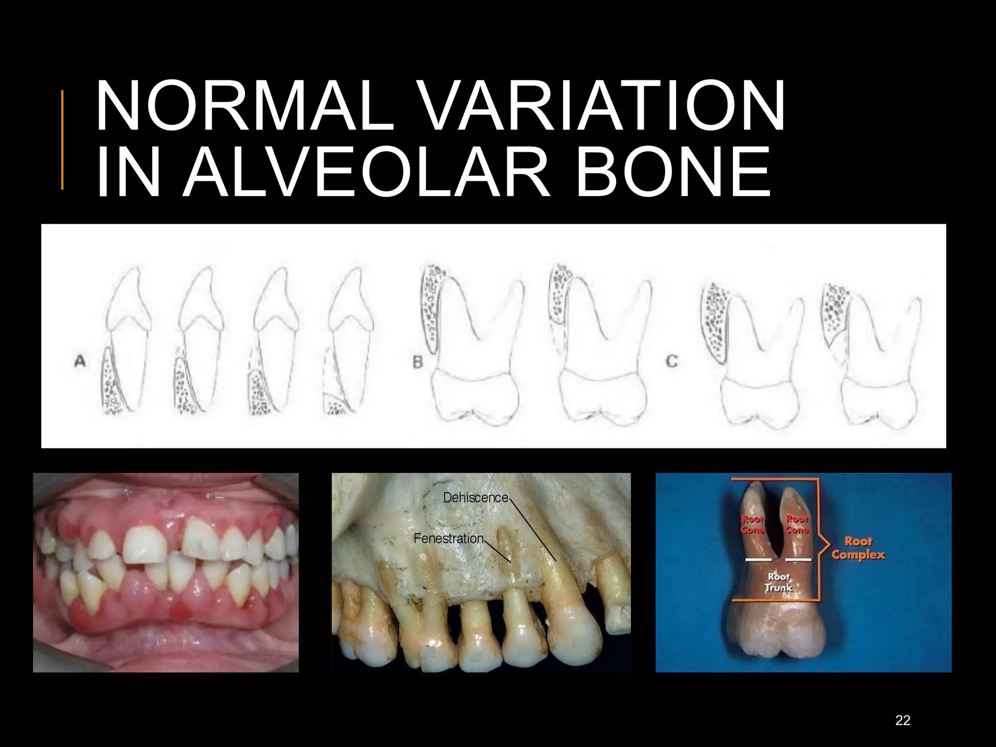 Periodontal bone defects | PPTX