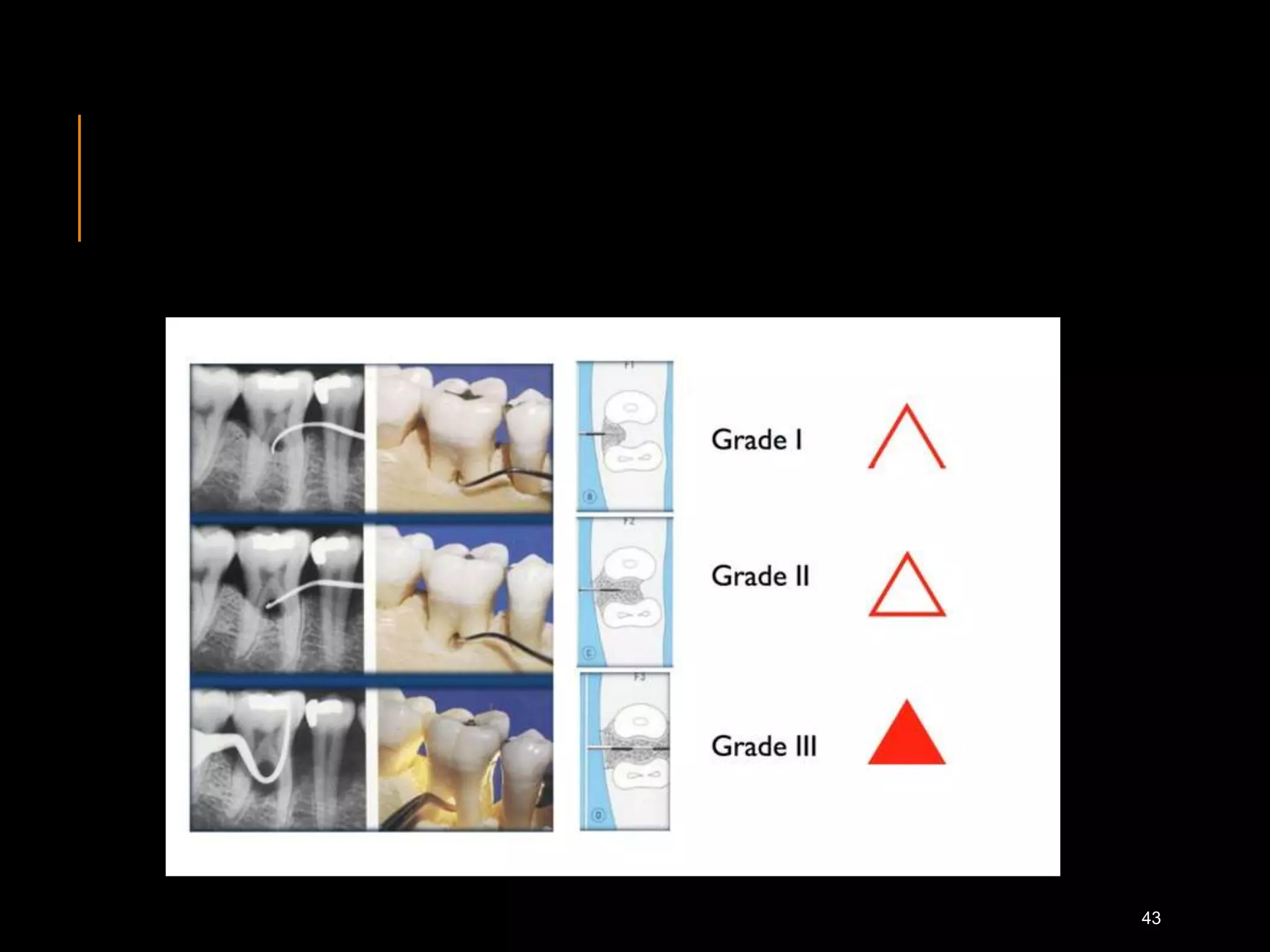 Periodontal bone defects | PPTX | Dental Health | Diseases and Conditions