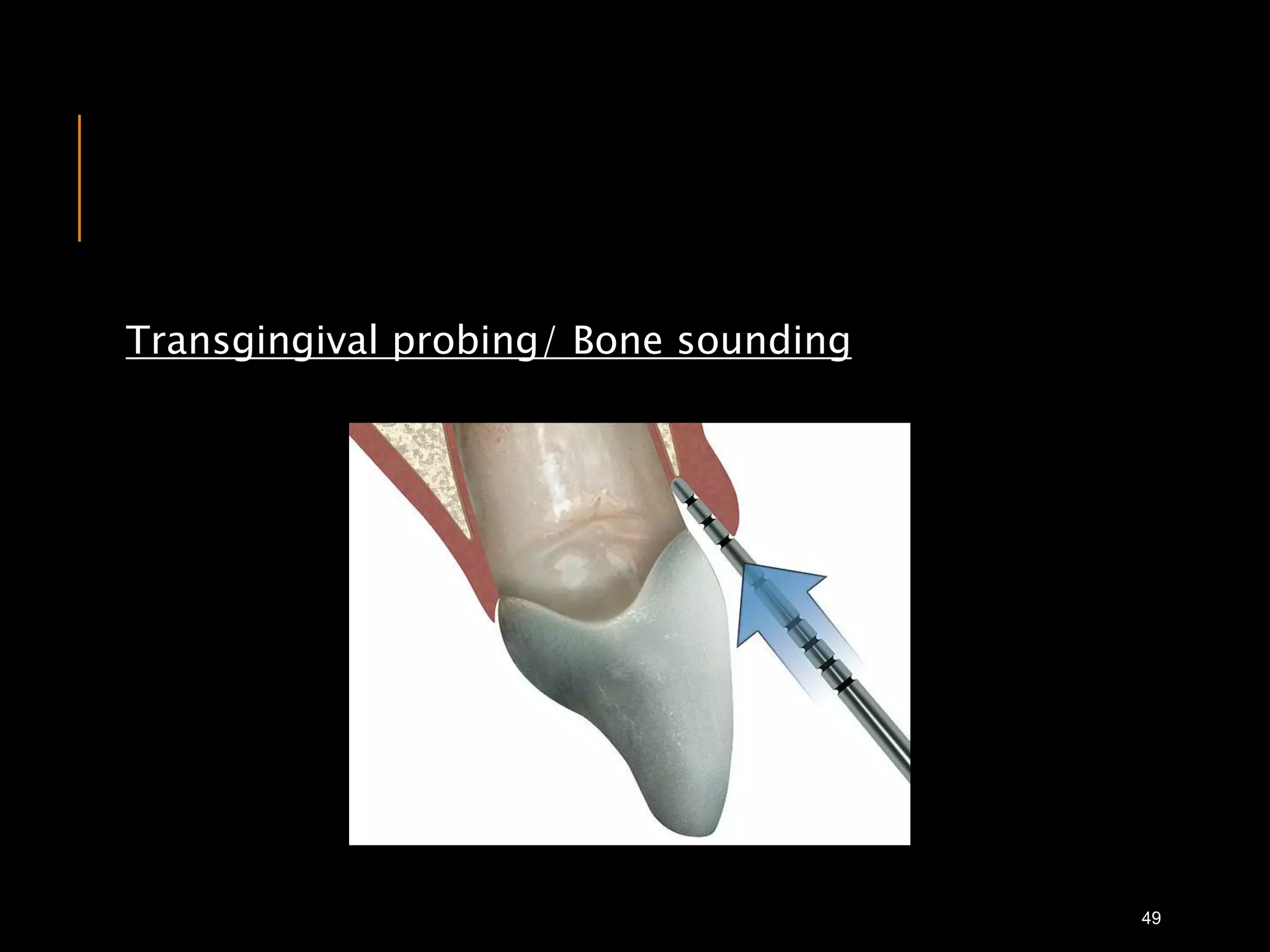 Periodontal bone defects | PPTX