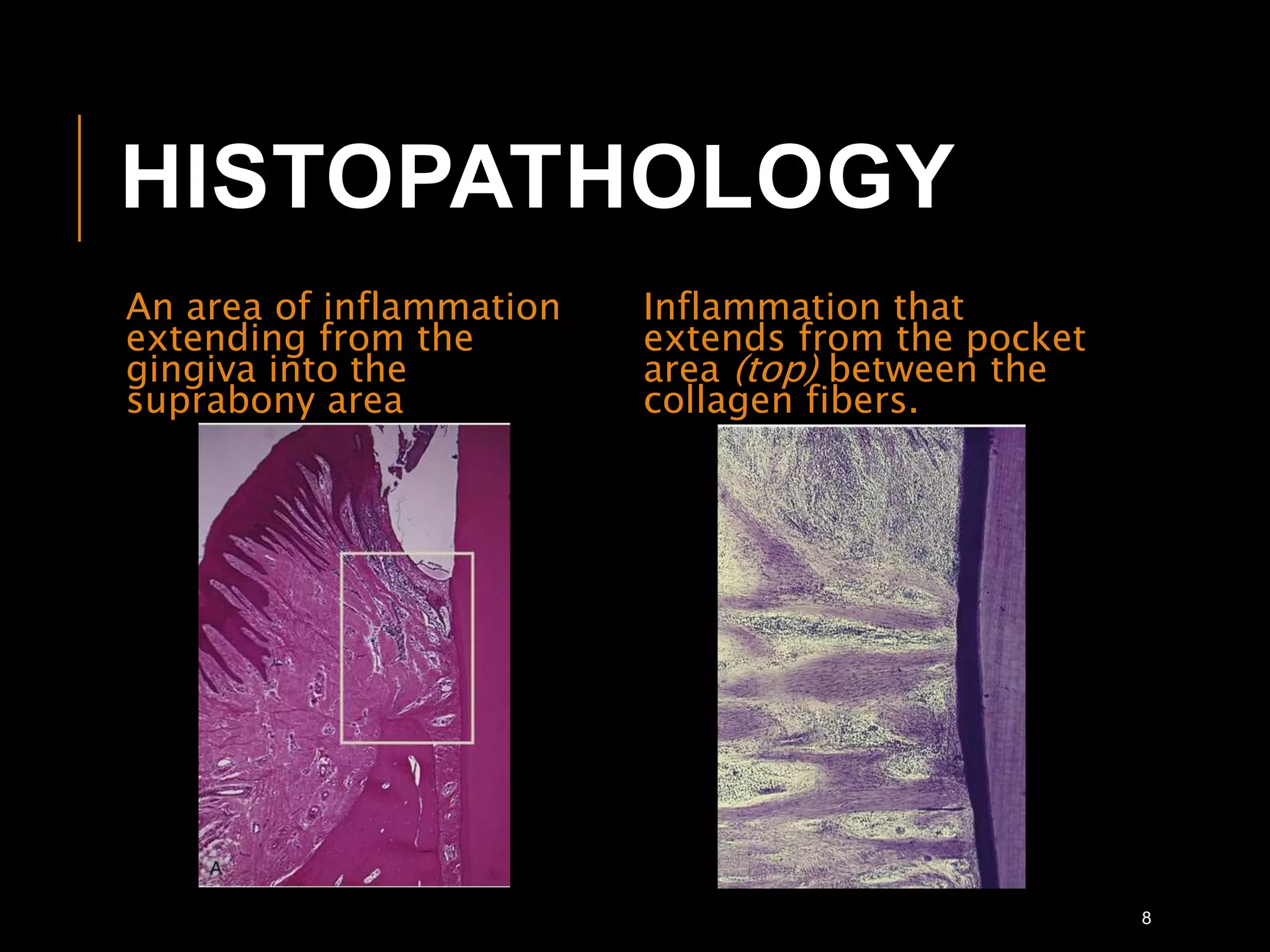Periodontal bone defects | PPTX