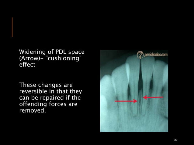 Periodontal bone defects | PPTX | Dental Health | Diseases and Conditions
