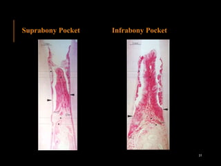 Periodontal bone defects | PPTX