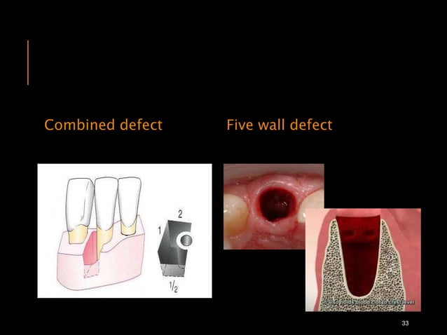 Periodontal bone defects | PPTX | Dental Health | Diseases and Conditions