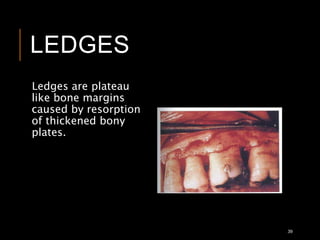 Periodontal bone defects | PPTX