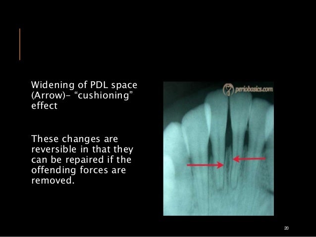 Periodontal bone defects