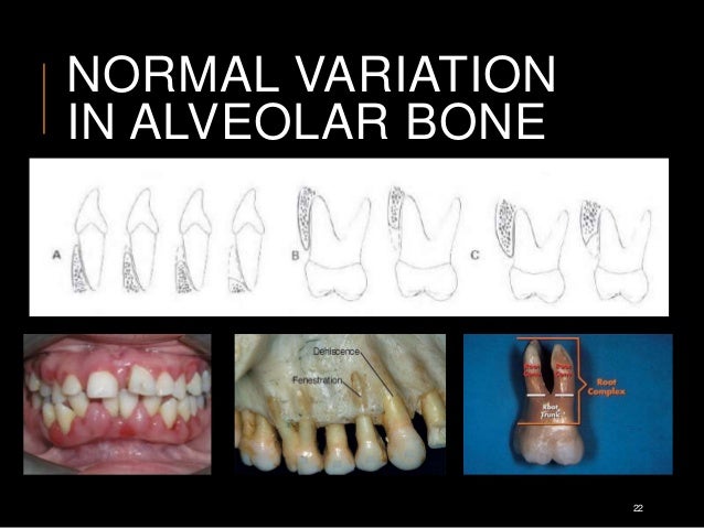Periodontal bone defects
