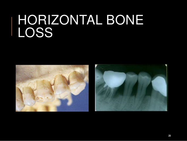 Periodontal bone defects