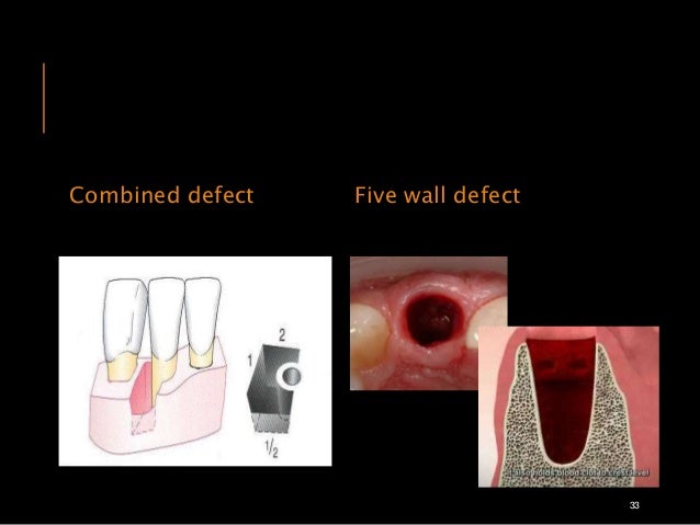 Periodontal bone defects