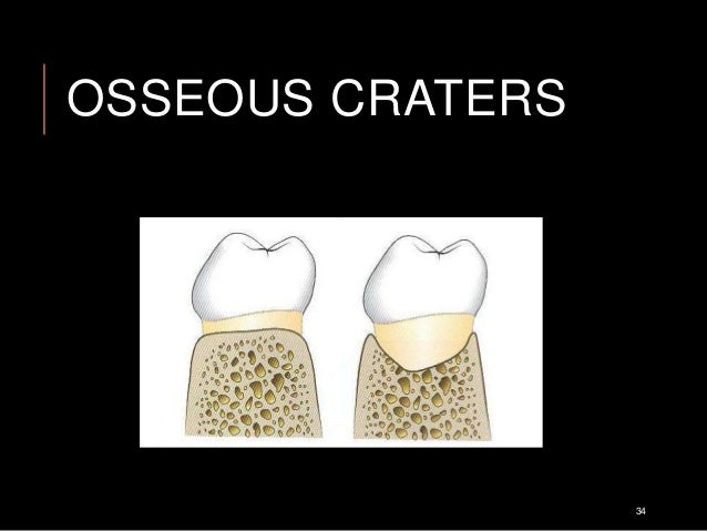 Periodontal bone defects