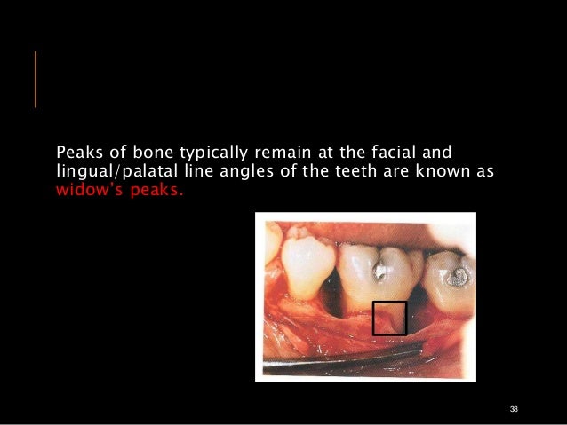 Periodontal bone defects
