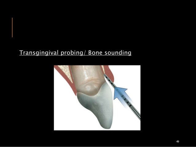 Periodontal bone defects