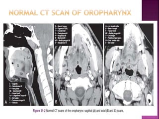 Normal Oropharynx
