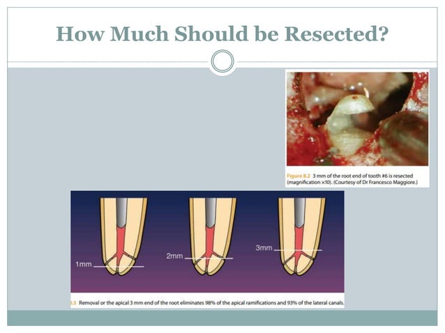 Apicectomy | PPTX | Dental Health | Diseases and Conditions