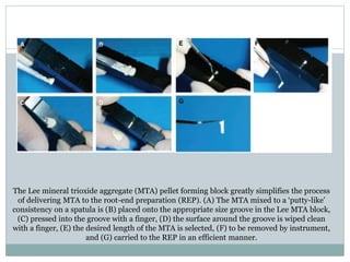 Apicectomy | PPTX