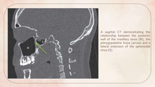 SEMINAR 13 - OAC AND OAF - introduction , surgical anatomy of maxillary ...