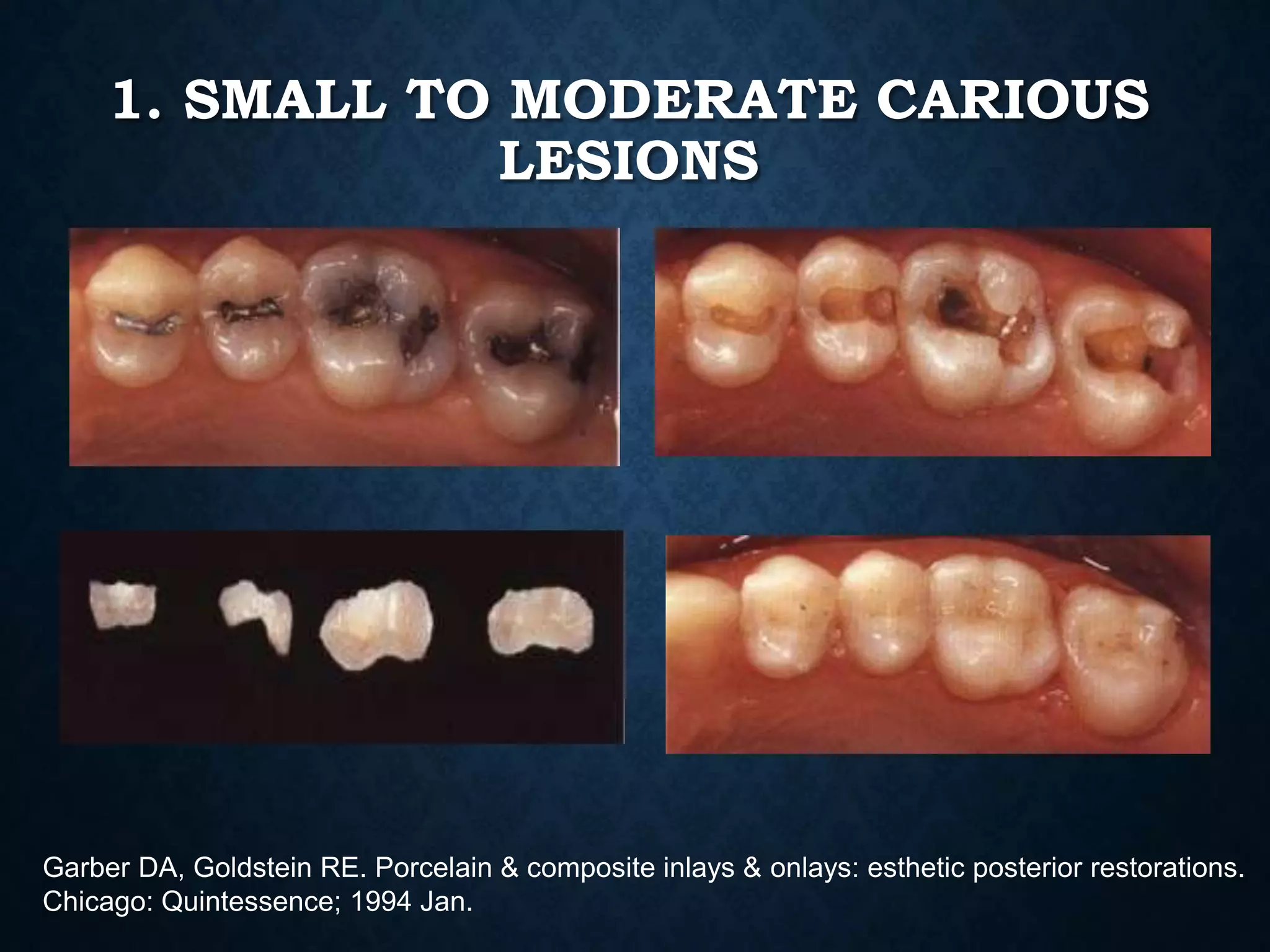 Ceramic inlays and onlays | PPTX